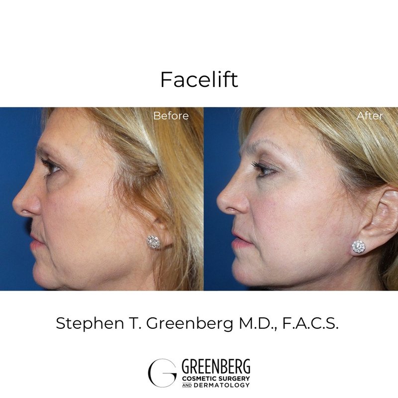 STEPHEN T. GREENBERG, MD - 50 Photos - Cosmetic Surgeons - 365 County ...